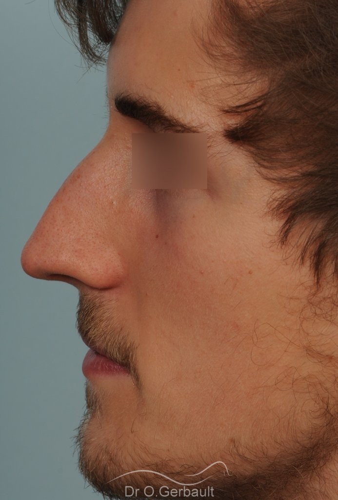 Photos de rhinoplastie chez l'homme, avant et après