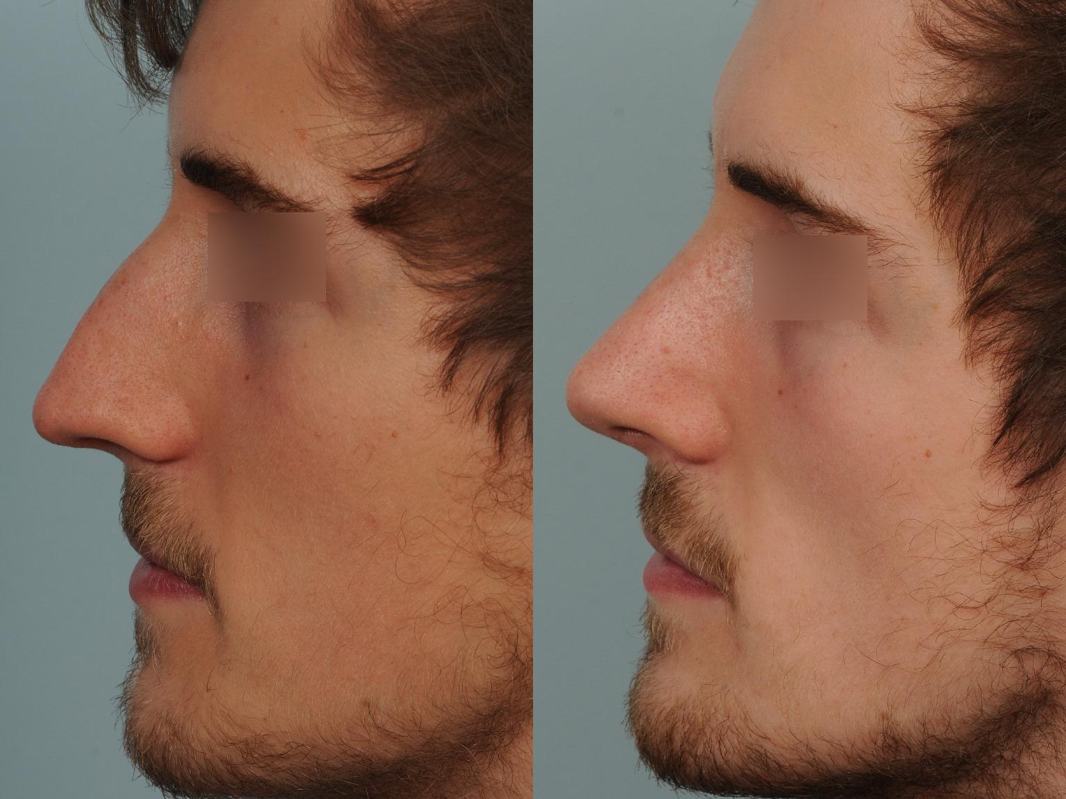 Photos de rhinoplastie avec nez dévié ou tordu, avant et après