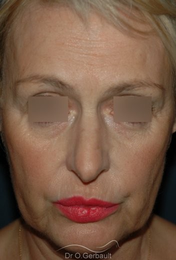 Photos avant et après des liftings du visage les mieux réussi