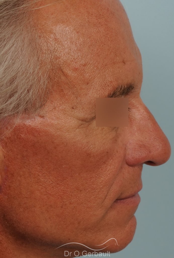 Photos avant et après des liftings du visage les mieux réussi