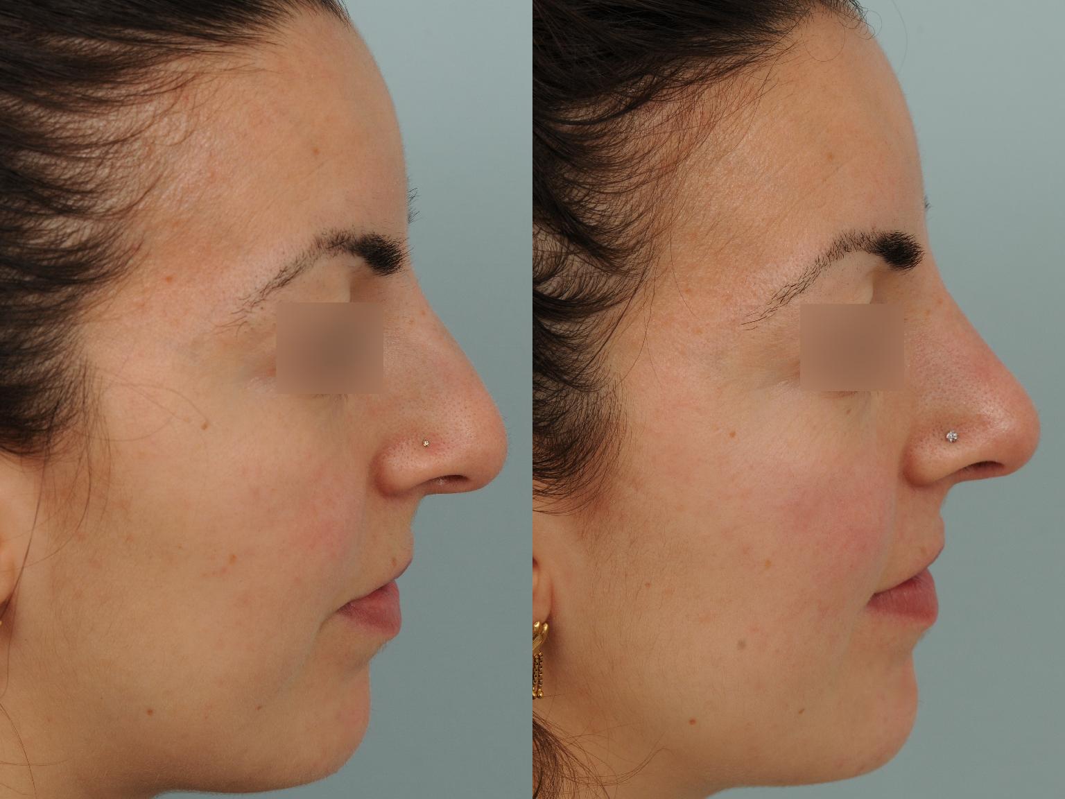 Photos de rhinoplastie avec nez trop large, avant et après : réduire le nez