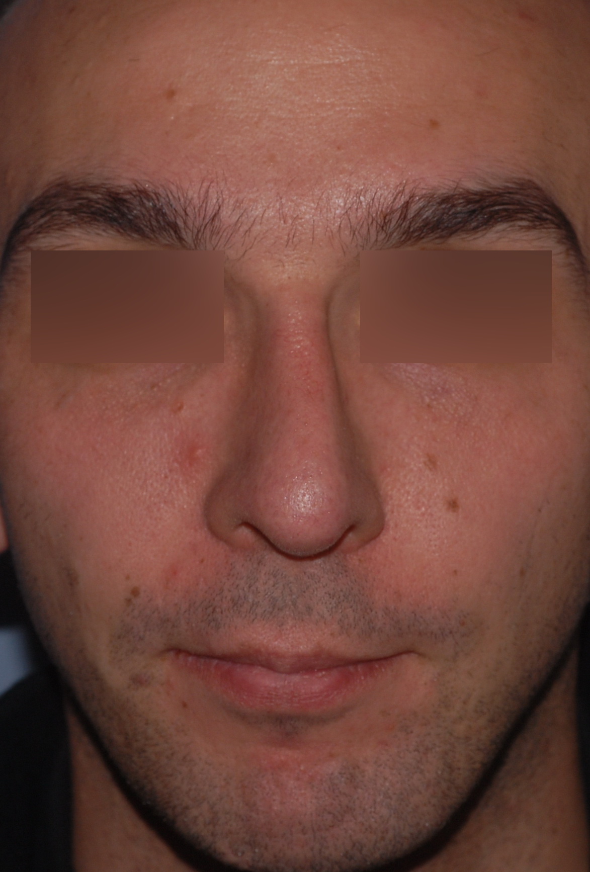 Archives des Male rhinoplasty - Chirurgien rhinoplastie Paris : Dr Gerbault