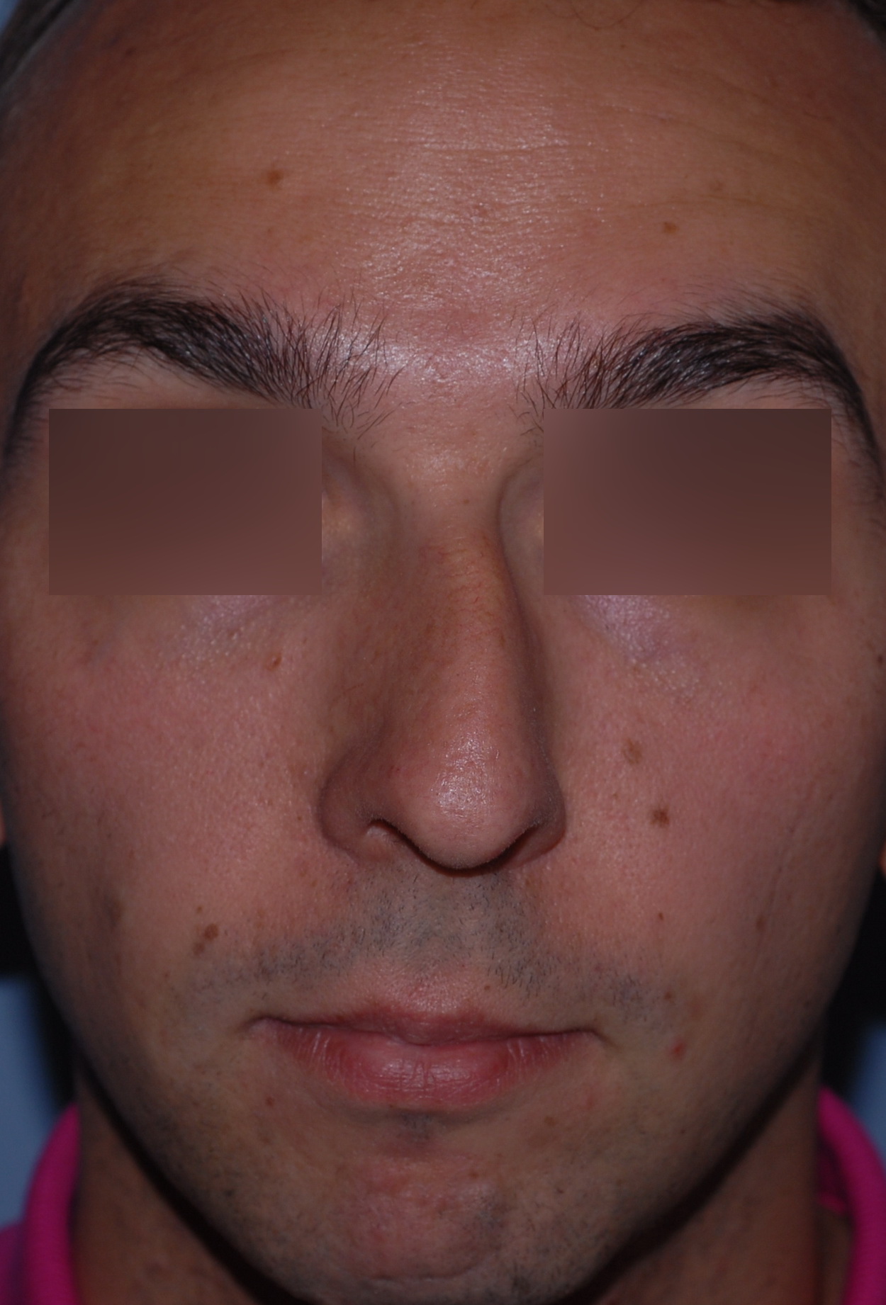 Archives des Male rhinoplasty - Chirurgien rhinoplastie Paris : Dr Gerbault