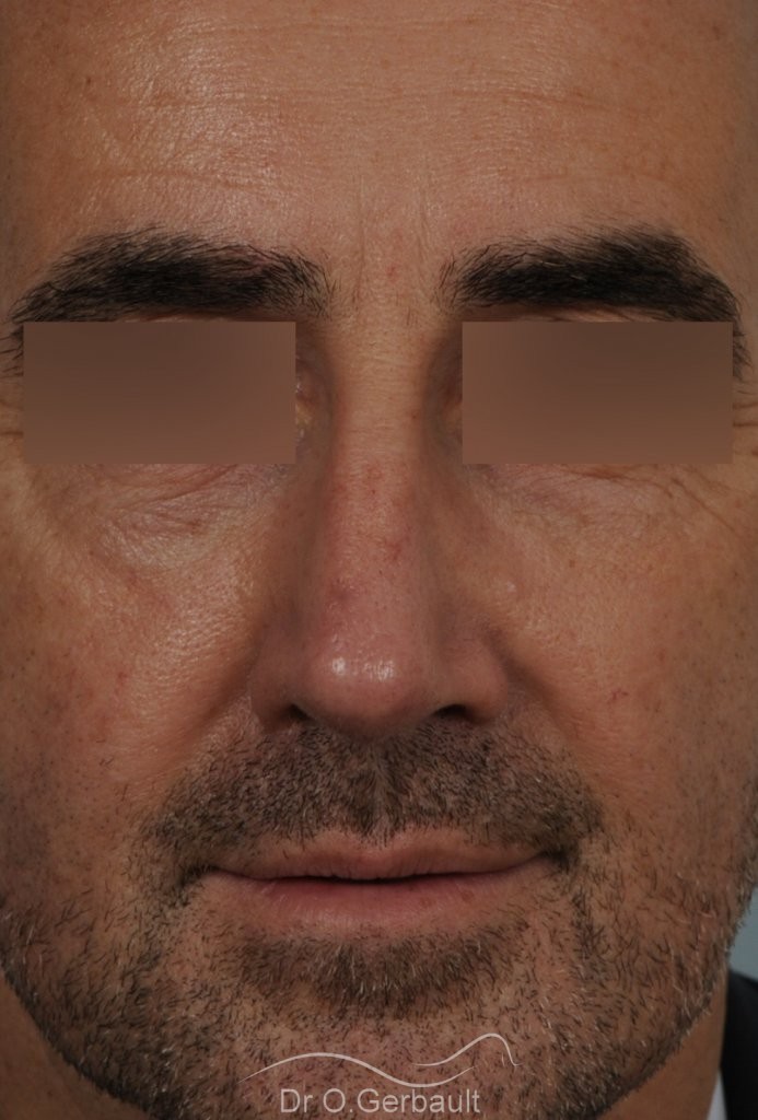 Archives des Male rhinoplasty - Chirurgien rhinoplastie Paris : Dr Gerbault