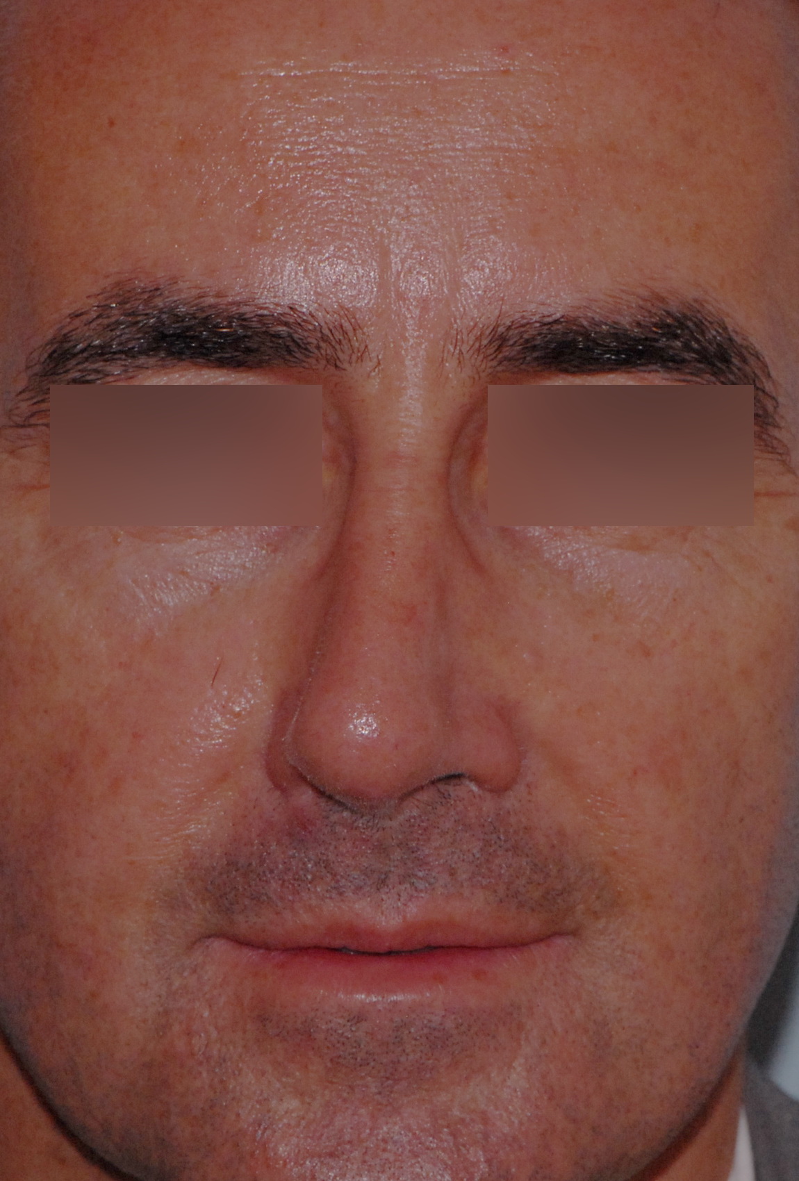 Archives des Male rhinoplasty - Chirurgien rhinoplastie Paris : Dr Gerbault