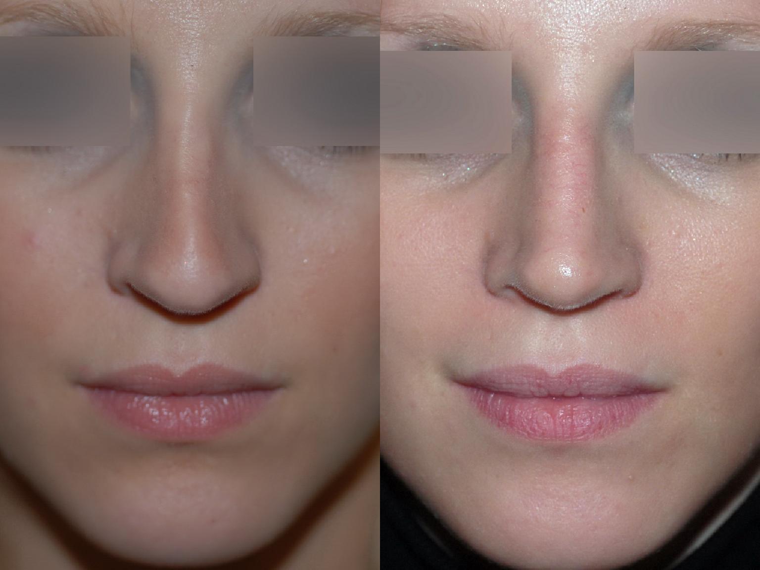 Photos de rhinoplastie ratée avant et après : deuxième rhinoplastie