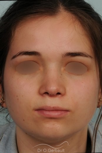 Syndrome de Binder : opération de rhinoplastie réparatrice