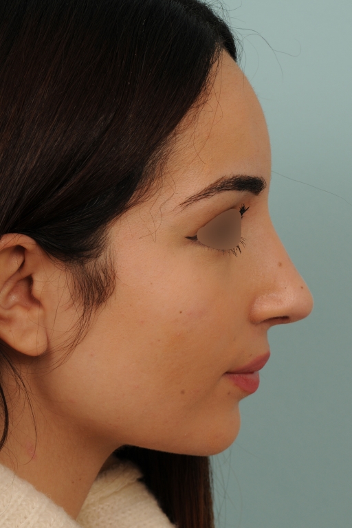 Photos de rhinoplastie avec pointe du nez trop large, avant et après