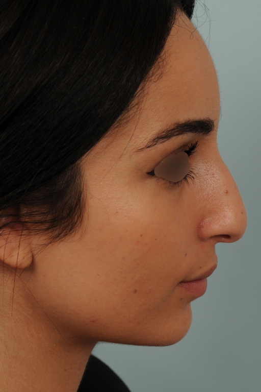 Photos de rhinoplastie avec pointe du nez trop large, avant et après