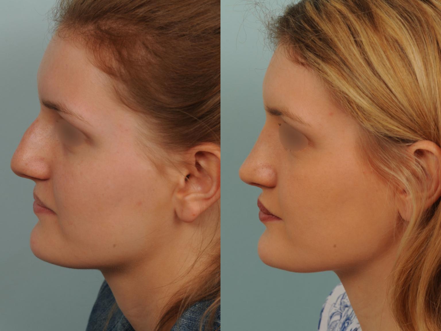 Archives des Cleft nose defect - Chirurgien rhinoplastie Paris : Dr ...