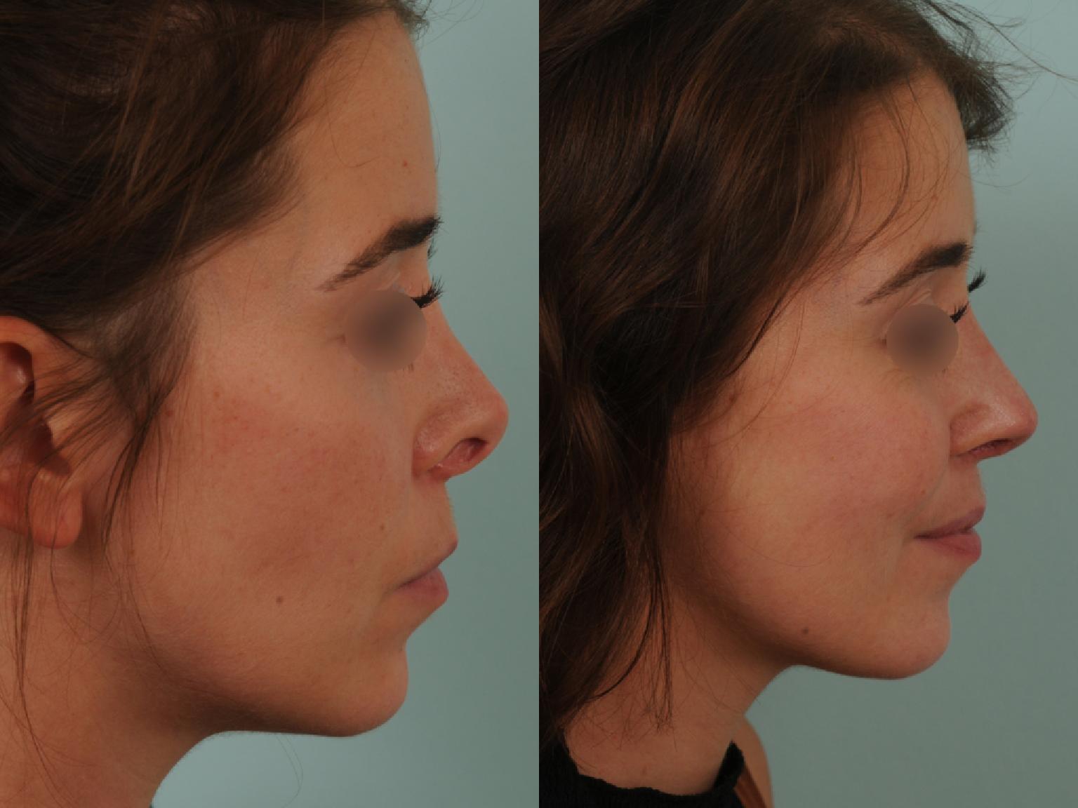 Rhinoplastie avant après : photos et exemples de nez refaits