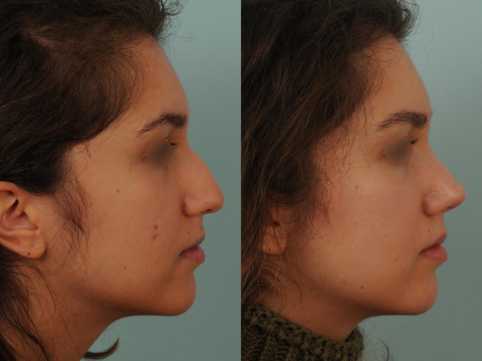 Rhinoplastie avant après : photos et exemples de nez refaits