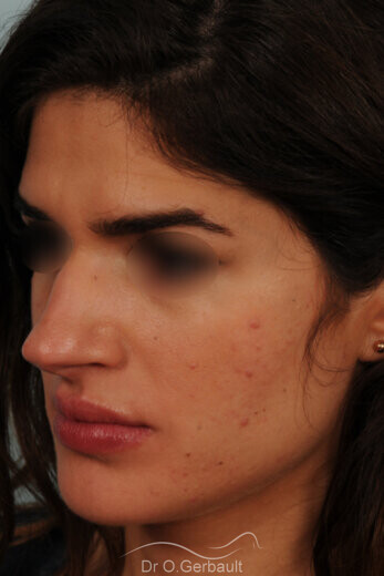 Photos de rhinoplastie avec nez trop large, avant et après : réduire le nez