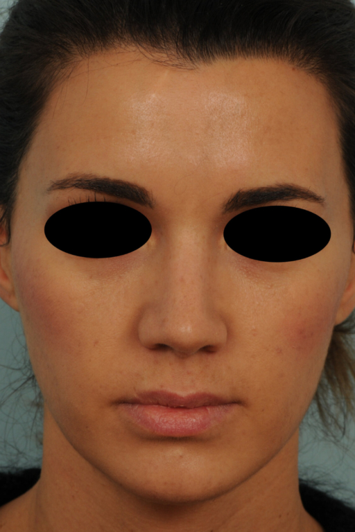 Photos de rhinoplastie avec nez trop large, avant et après : réduire le nez