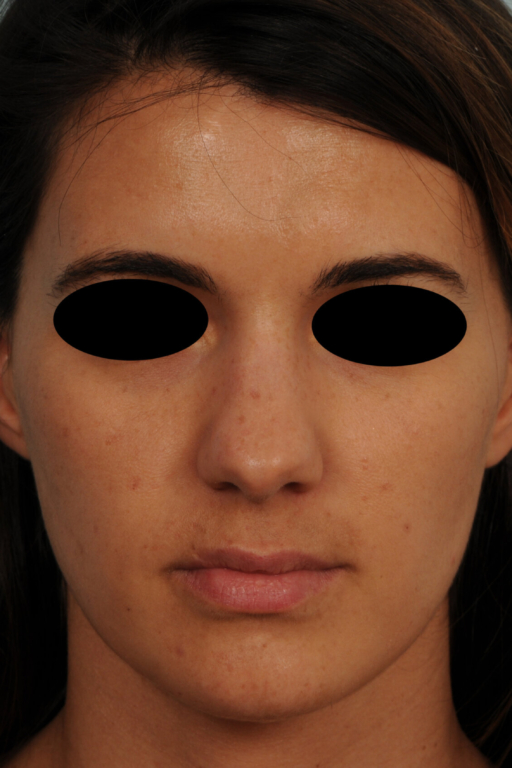 Photos de rhinoplastie avec nez trop large, avant et après : réduire le nez