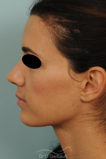 Photos de rhinoplastie avec nez trop large, avant et après : réduire le nez