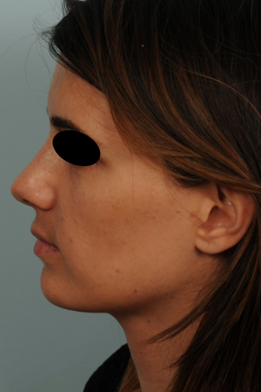Photos de rhinoplastie avec nez trop large, avant et après : réduire le nez