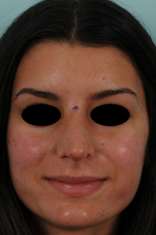 Rhinoplasty – evolution
