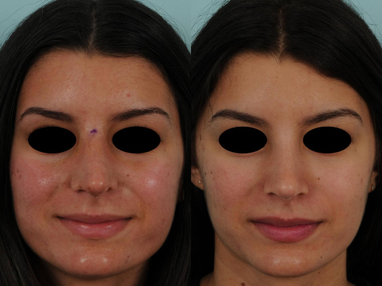 Rhinoplasty – evolution