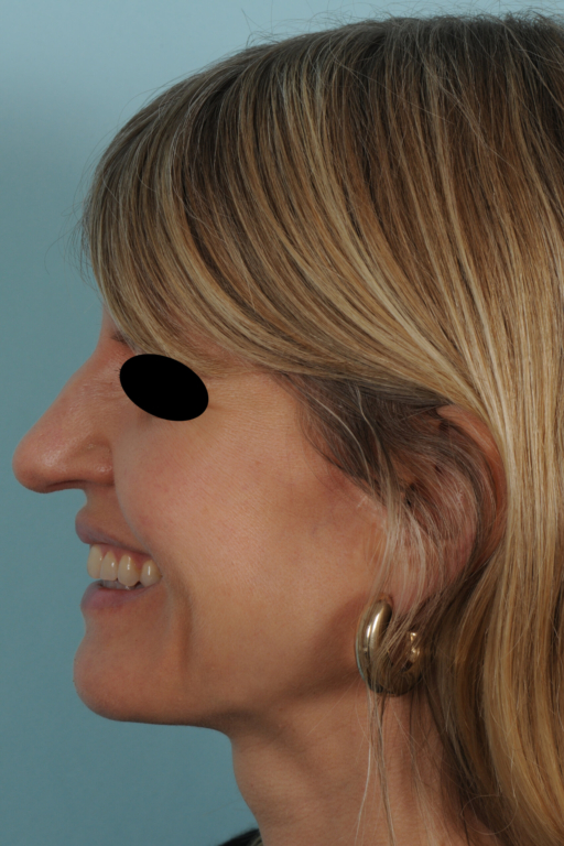 Photos de rhinoplastie avec nez trop large, avant et après : réduire le nez